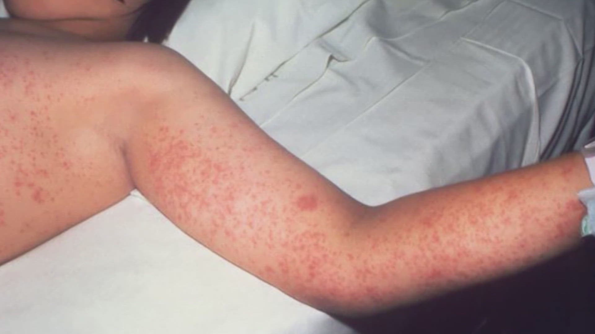 Measles outbreak continues in Texas, here's a look back at the 1990 ...