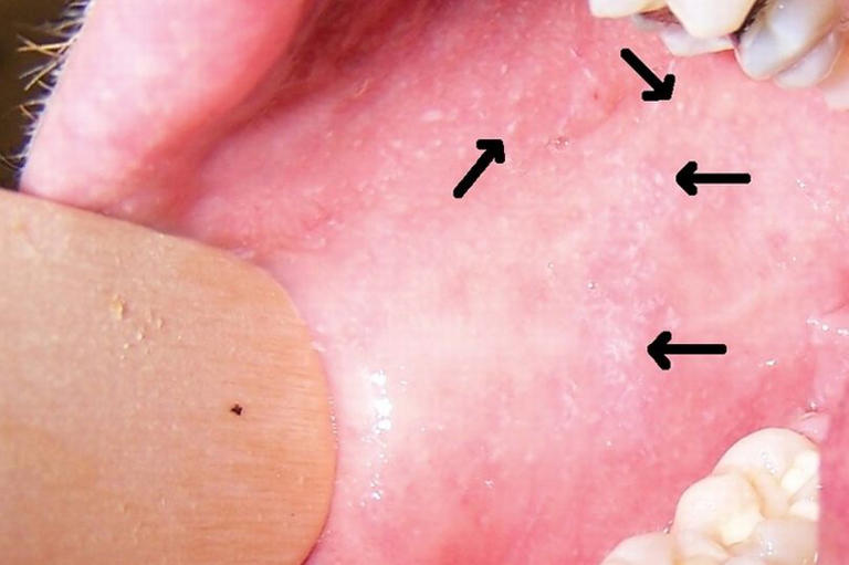 Lesser known measles symptom that can appear in the mouth before rash ...