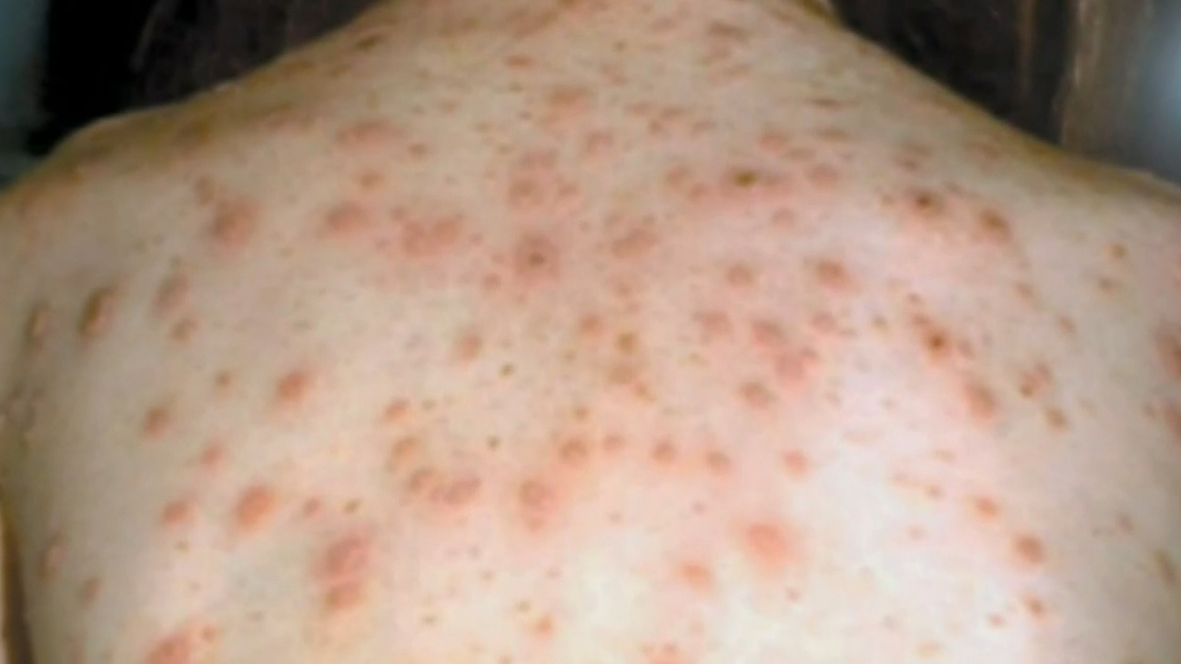 Fresh measles warnings in NSW and Victoria as new cases detected