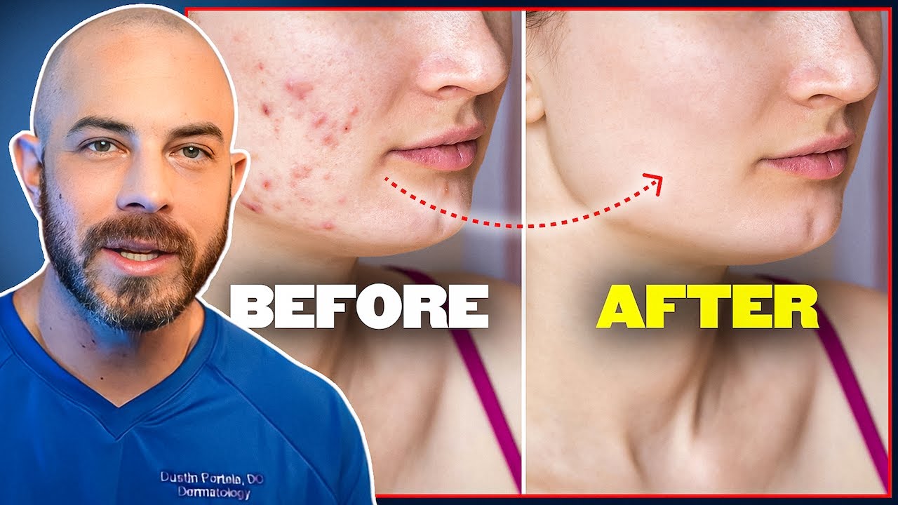 5 Acne Care Tips Everyone Should Know