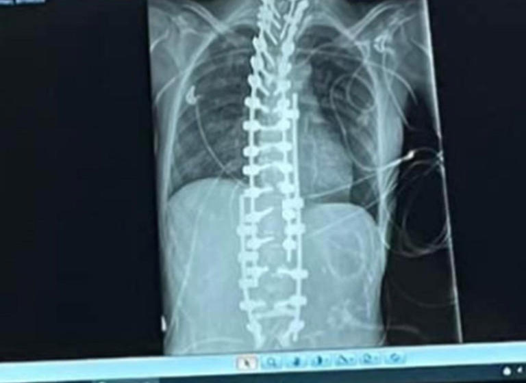 I haven’t had a bite of food in 10 years — a lifelong illness forces me ...