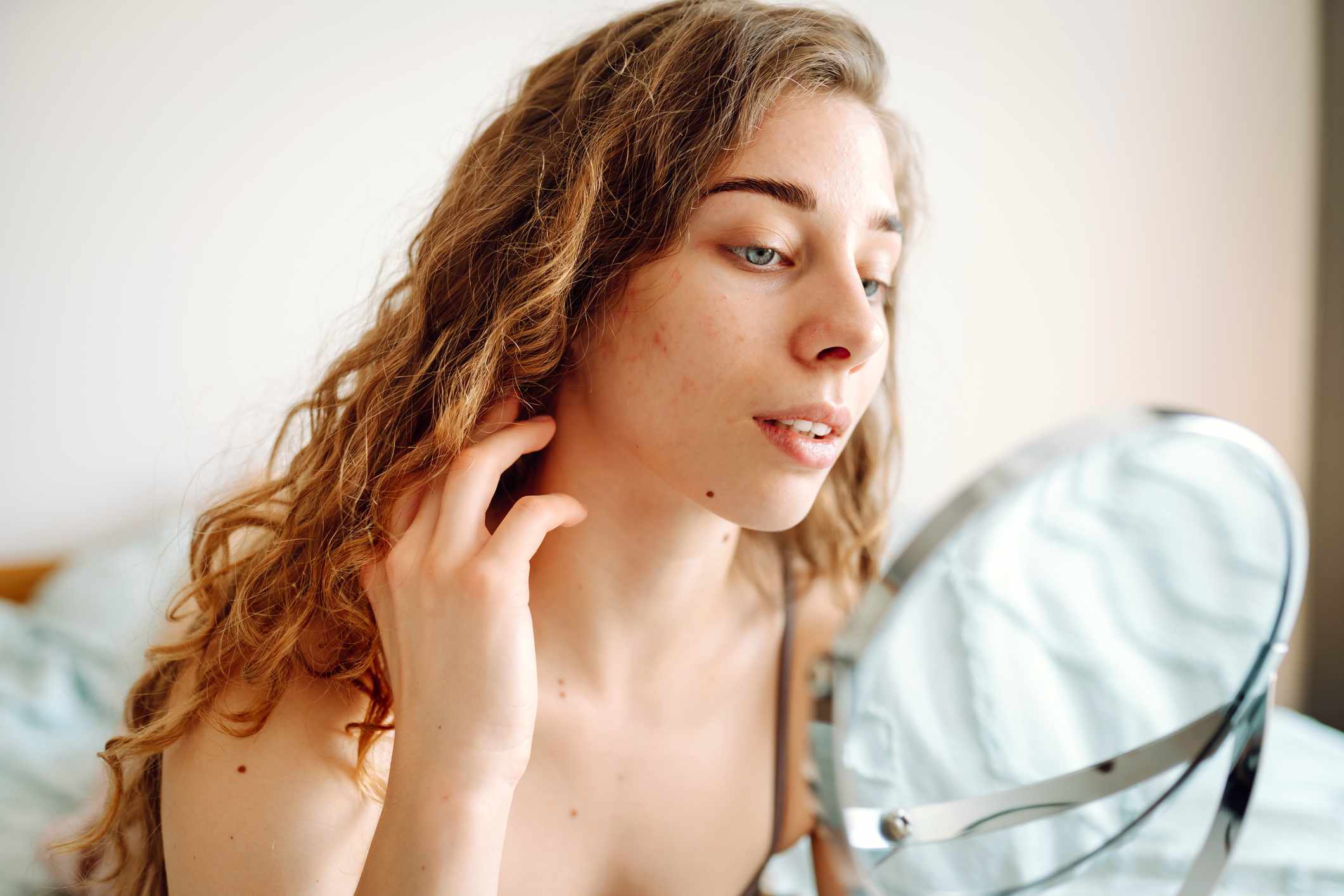 Acne face map: How to identify causes of your breakouts