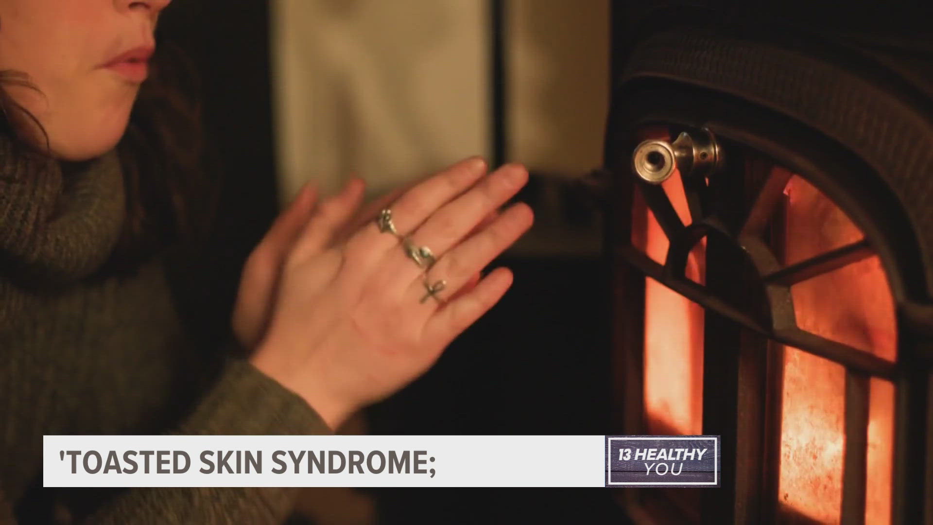 'Toasted skin syndrome' caused by hot water bottles, laptops, heating pads