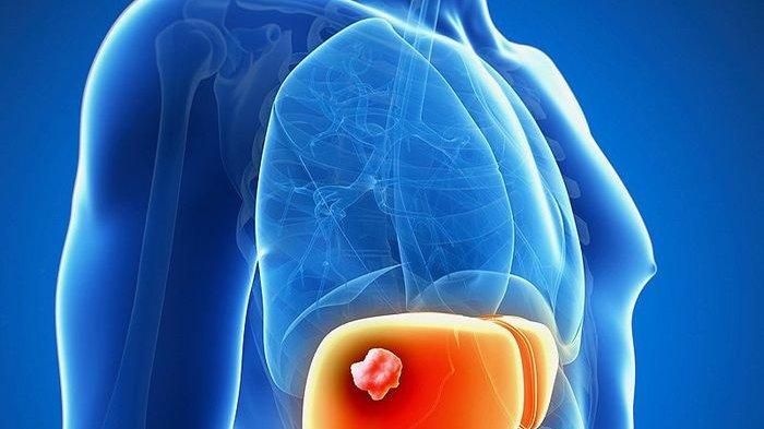 Hotman Paris Idap Abses Hati, Apa Efeknya Bagi Kesehatan Tubuh? Simak ...