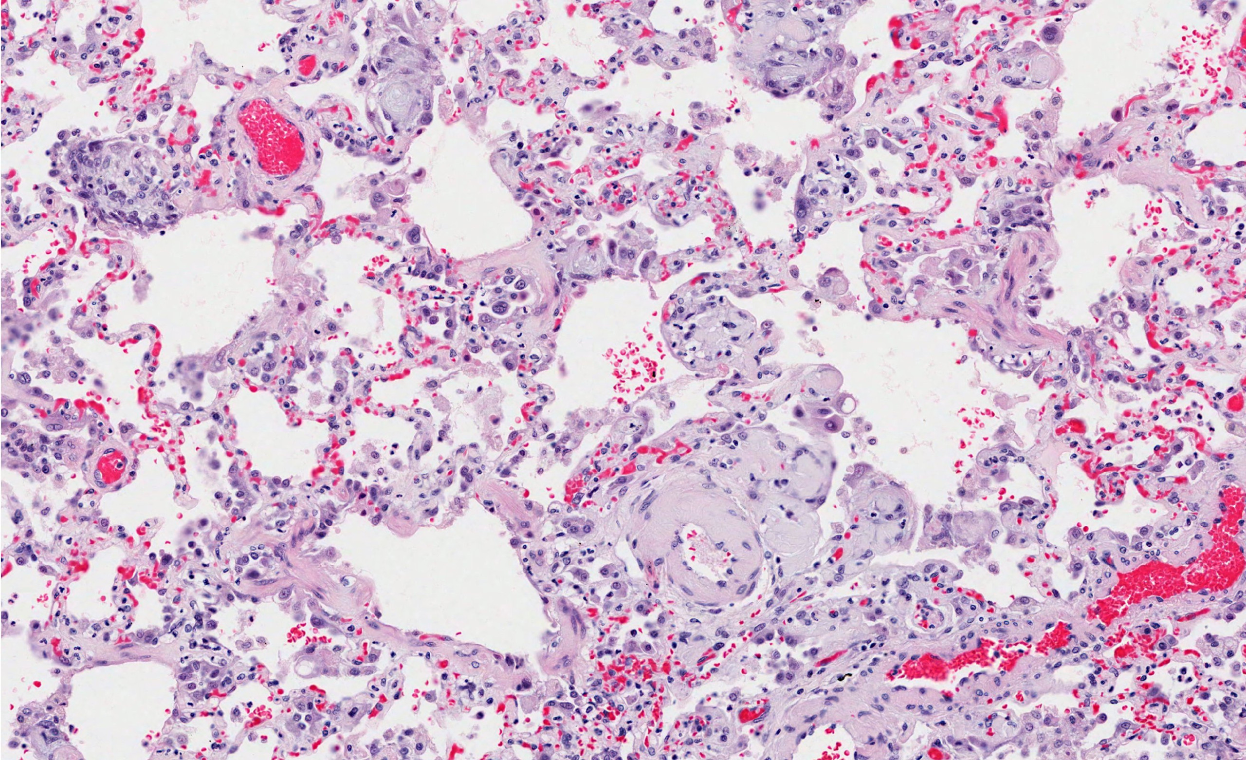 Amyloidosis: A closer look at this rare disease