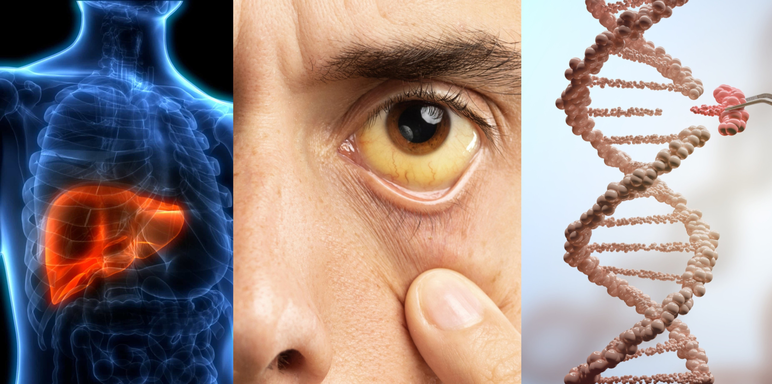 Maladie de Wilson : symptômes, causes et traitements