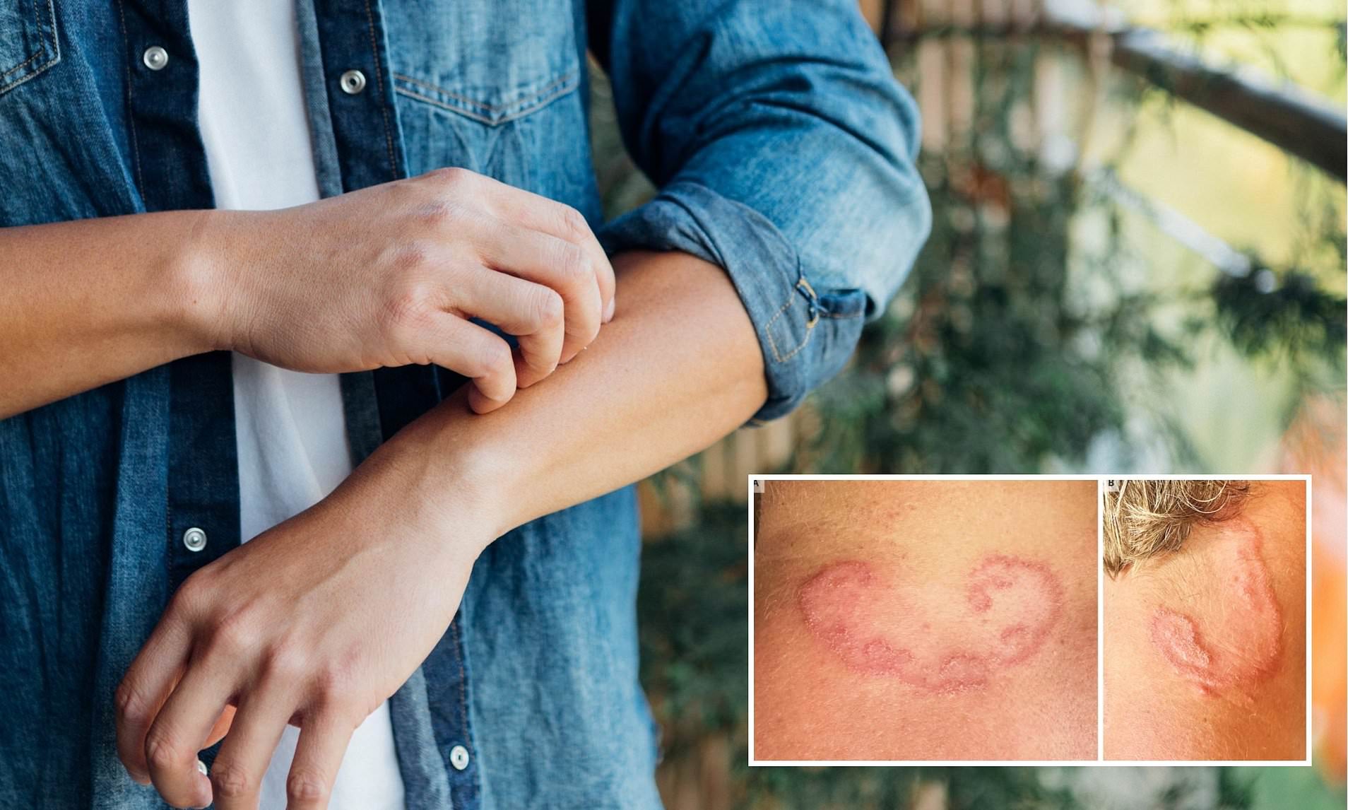 Teen's rash turned out to be parasitic worms burrowing under his flesh