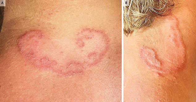 Teen's rash turned out to be parasitic worms burrowing under his flesh