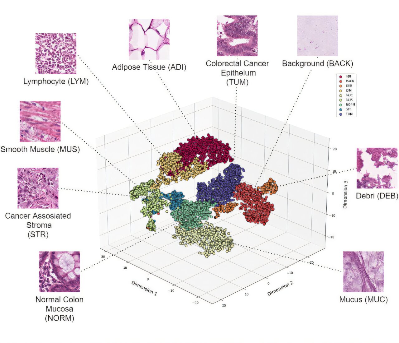 New AI tool surpasses previous methods in colorectal cancer tissue analysis