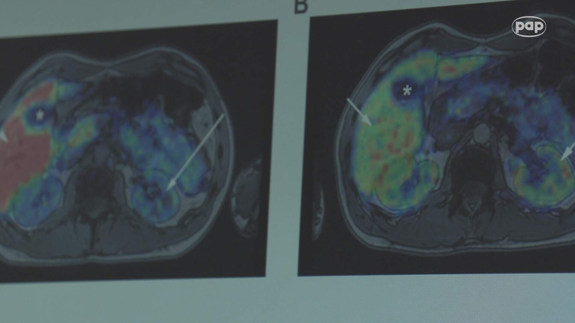 Rzadka choroba Wilsona o mnogich objawach