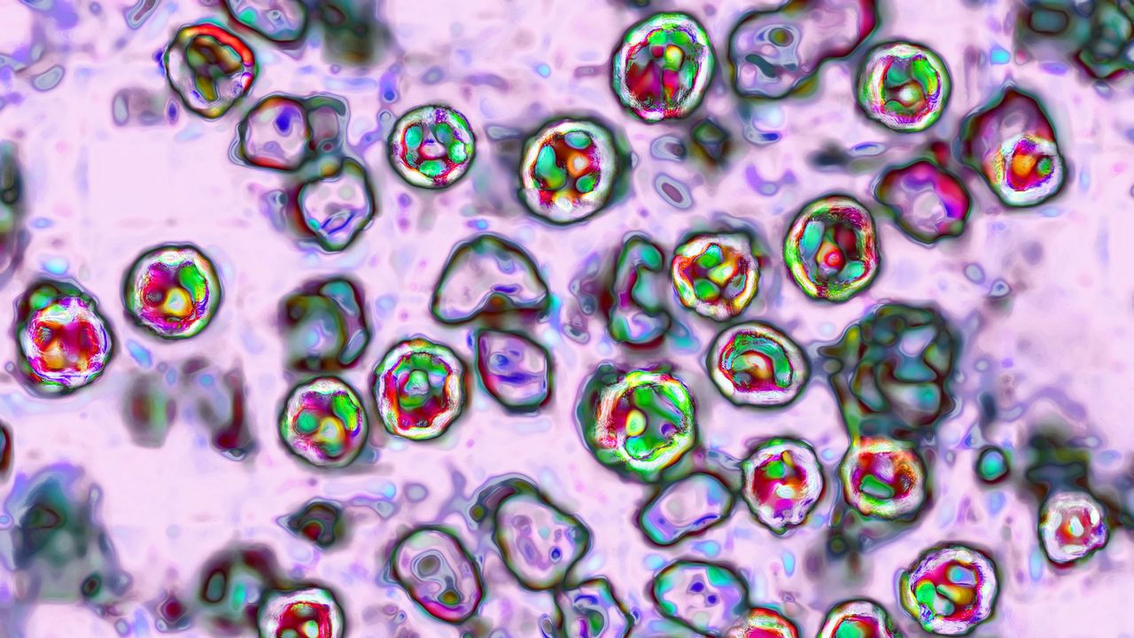 Tracking measles cases in the U.S. as number of infections surpass ...