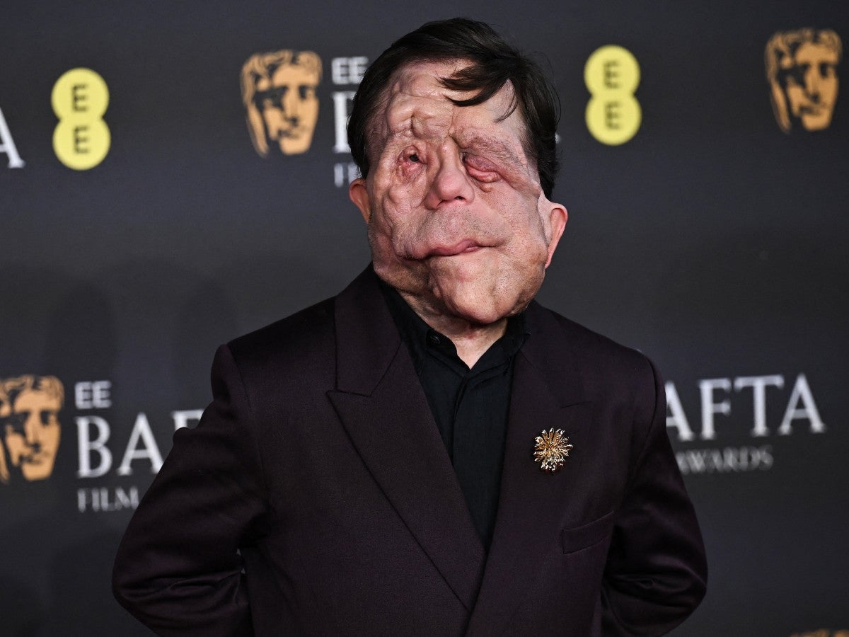 ¿Quién es Adam Pearson, actor de 'Un hombre diferente', y qué le pasó ...