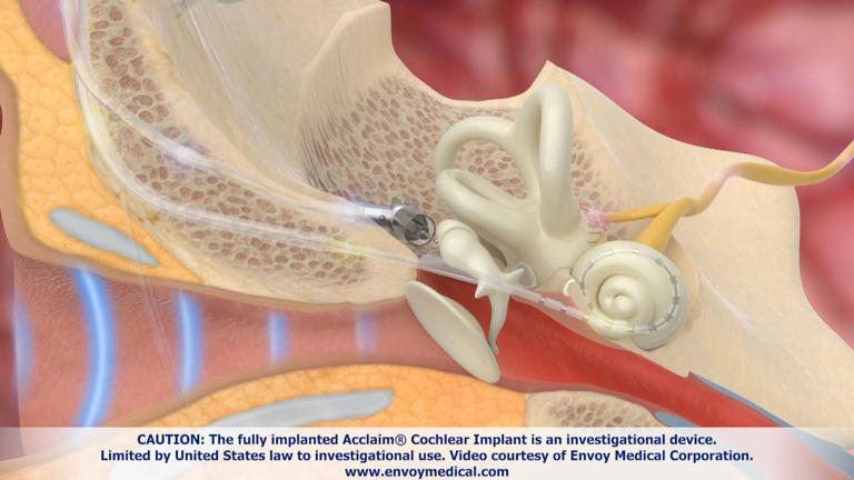 MUSC first in country to lead a brand-new cochlear implant trial