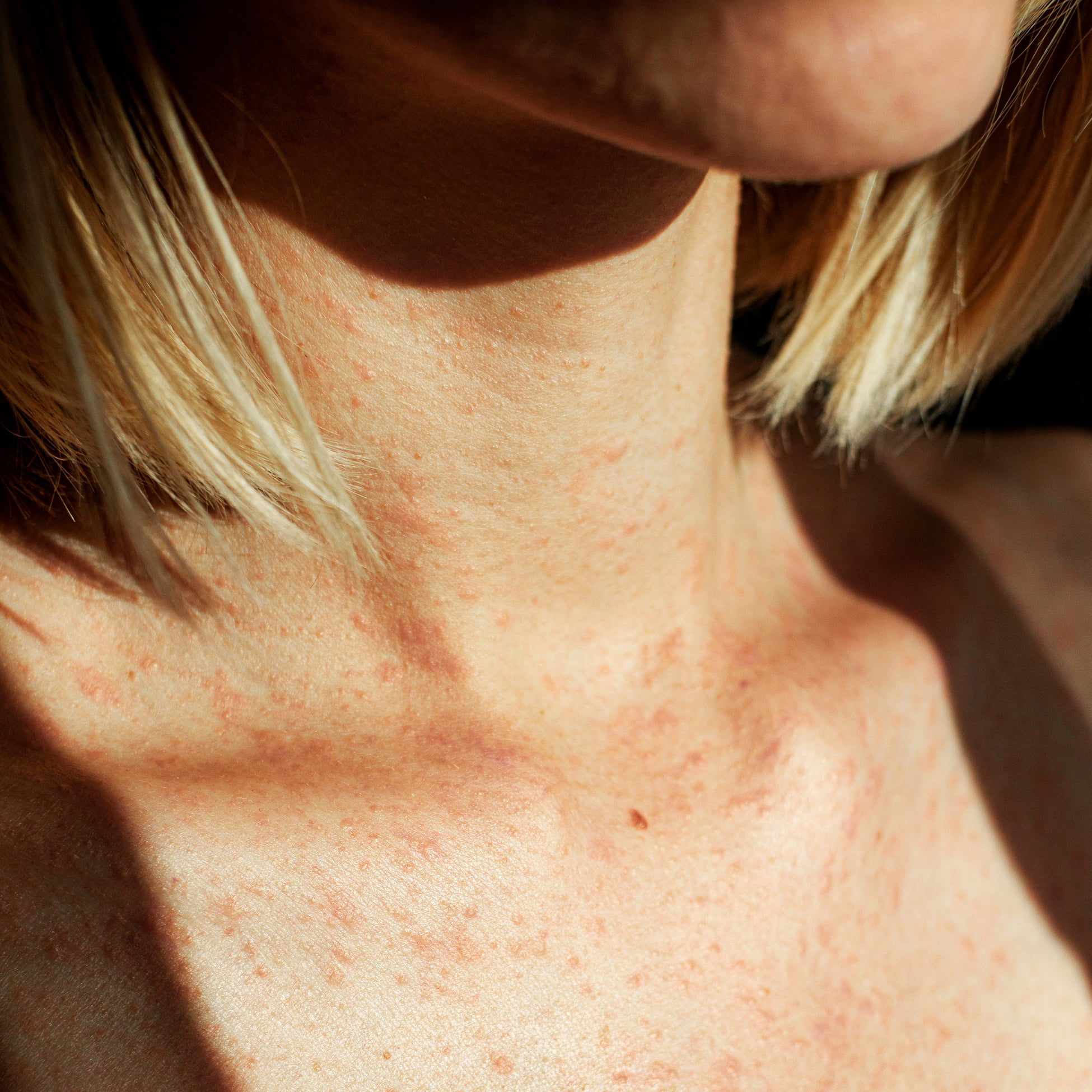 5 Little-Known Tips For Eczema That Actually Work, According to Derms 5 Little-Known Tips For Eczema That Actually Work, According to Derms