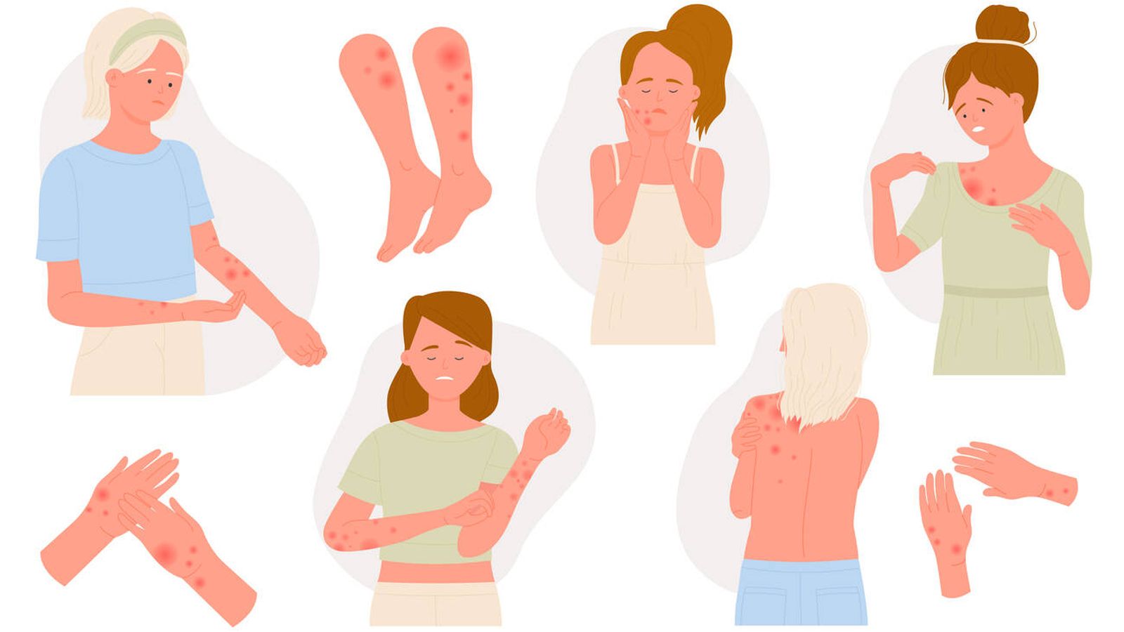 Los riesgos para la salud de la urticaria por frío: de las ronchas ...