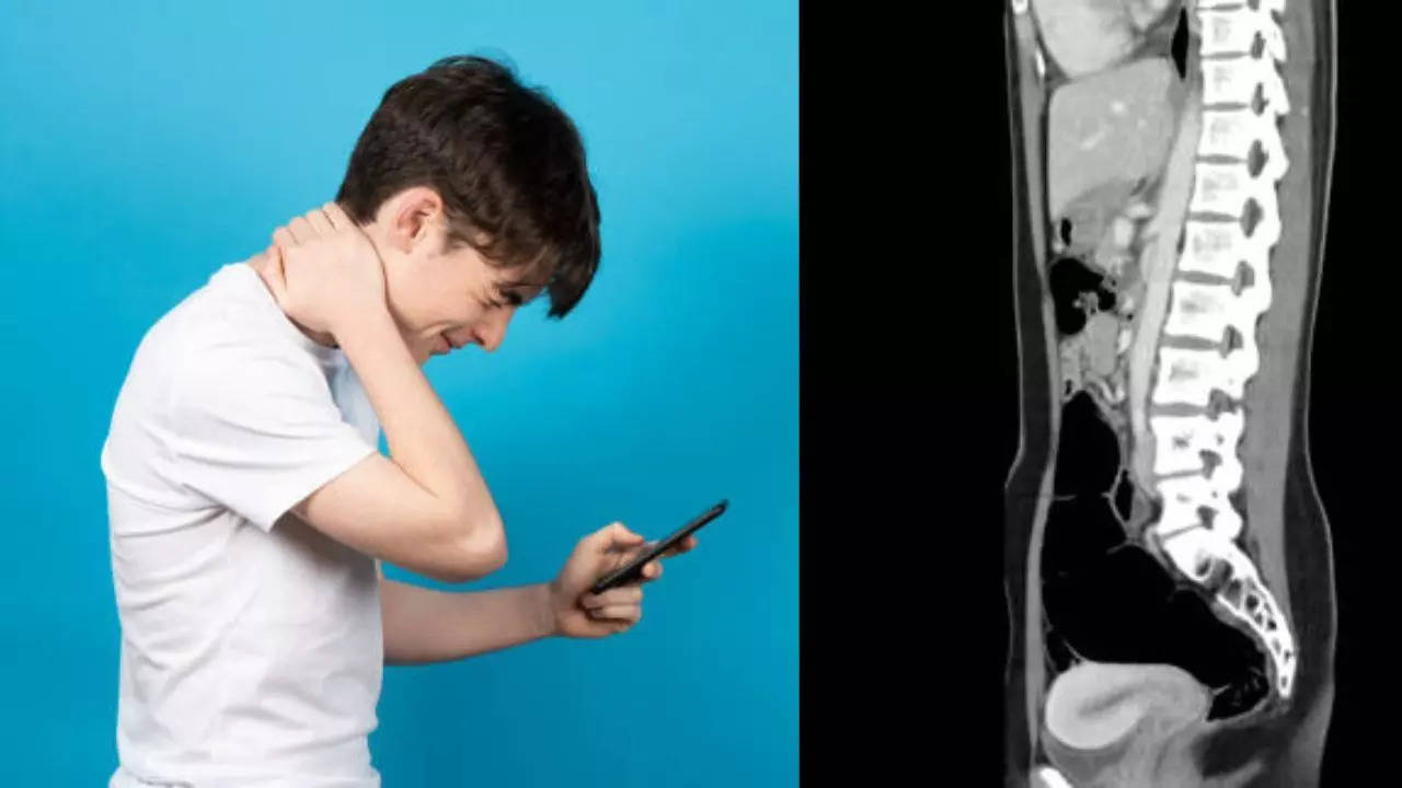 What is Scheuermann's kyphosis, A Skeletal Disorder That Can Cause ...