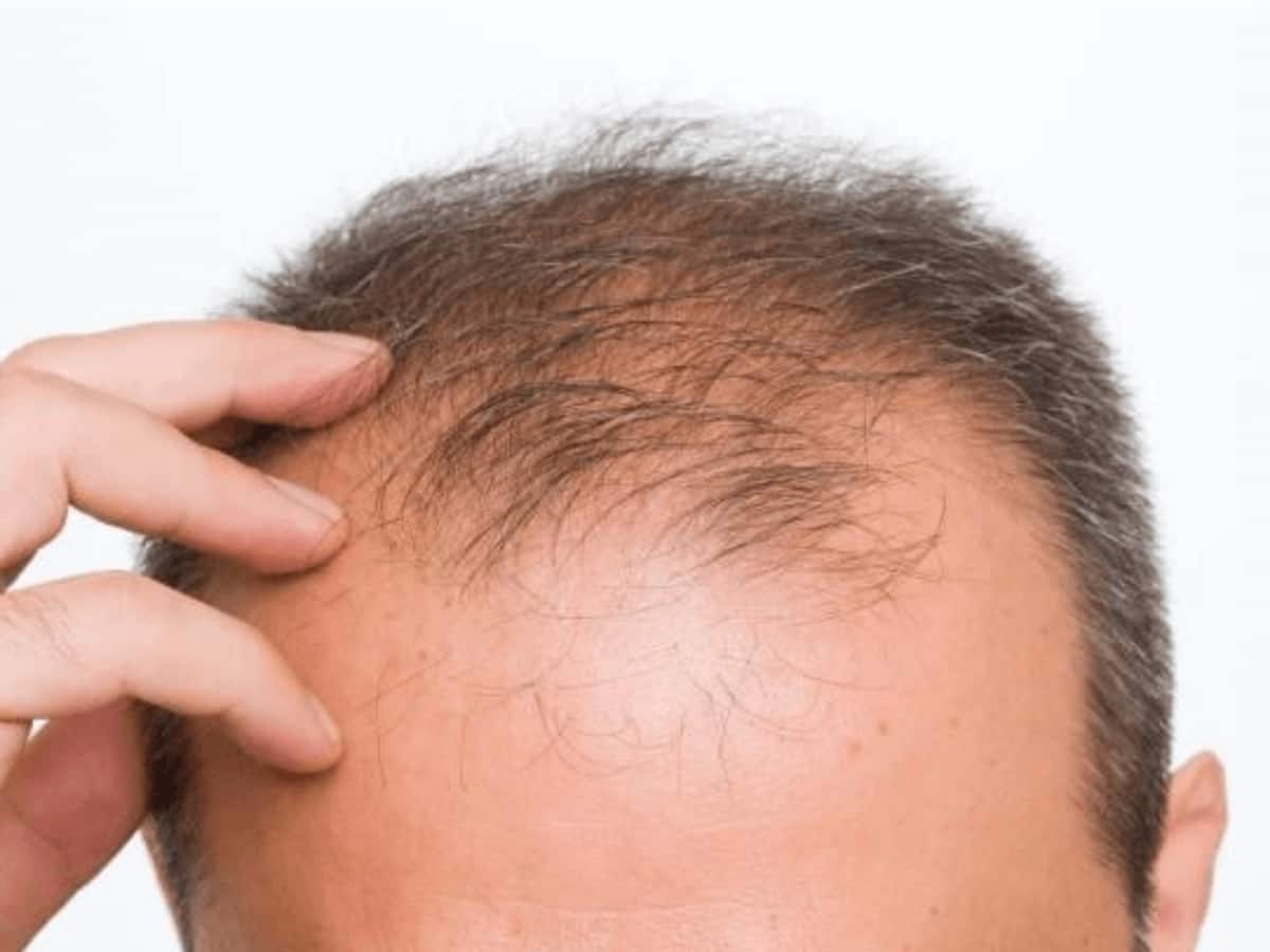 What Causes Sudden Hair Fall? When To See A Dermatologist