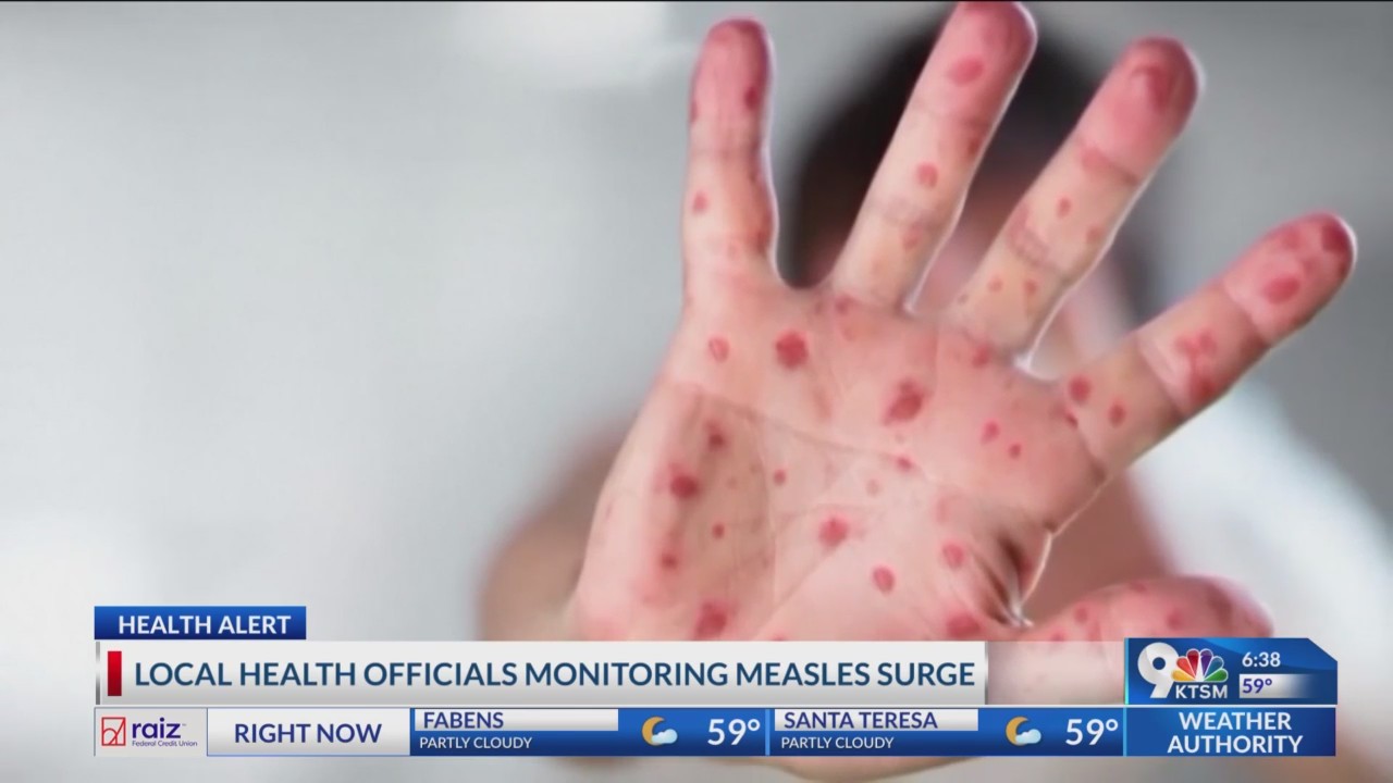 Health officials monitoring measles surge