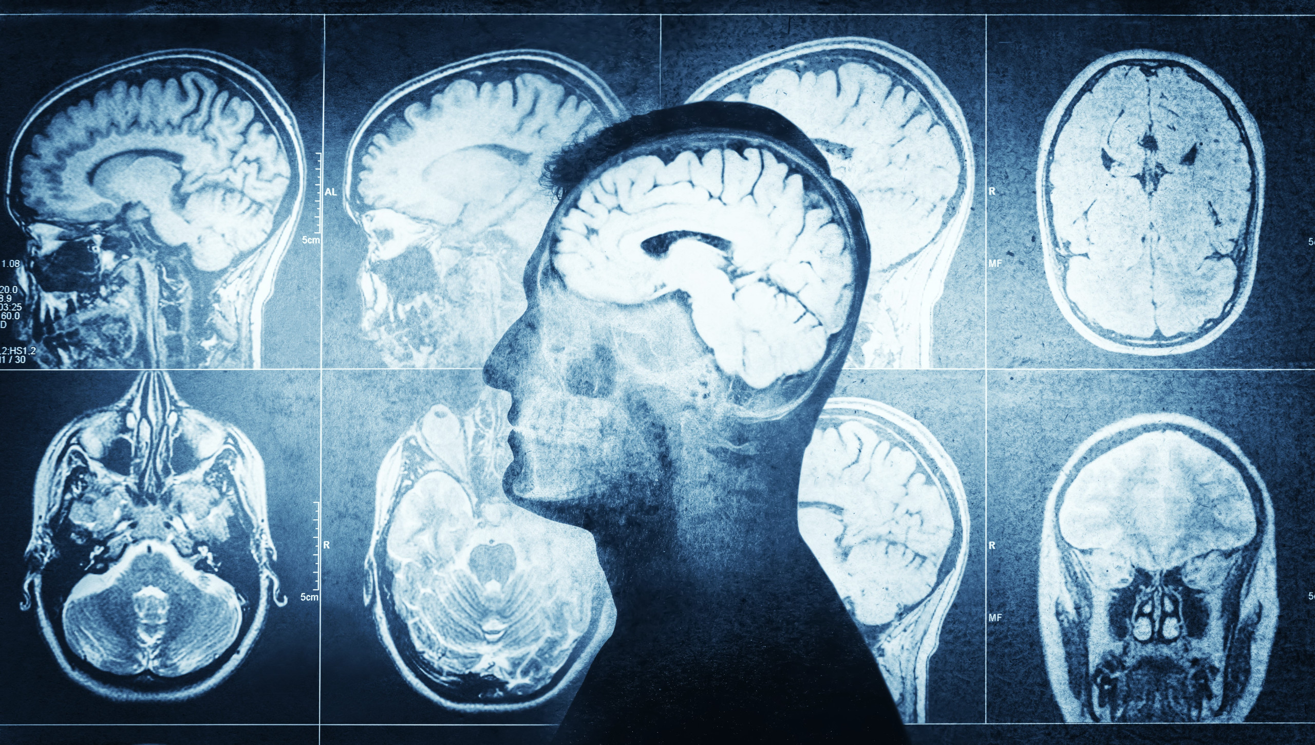 The six types of depression, according to science