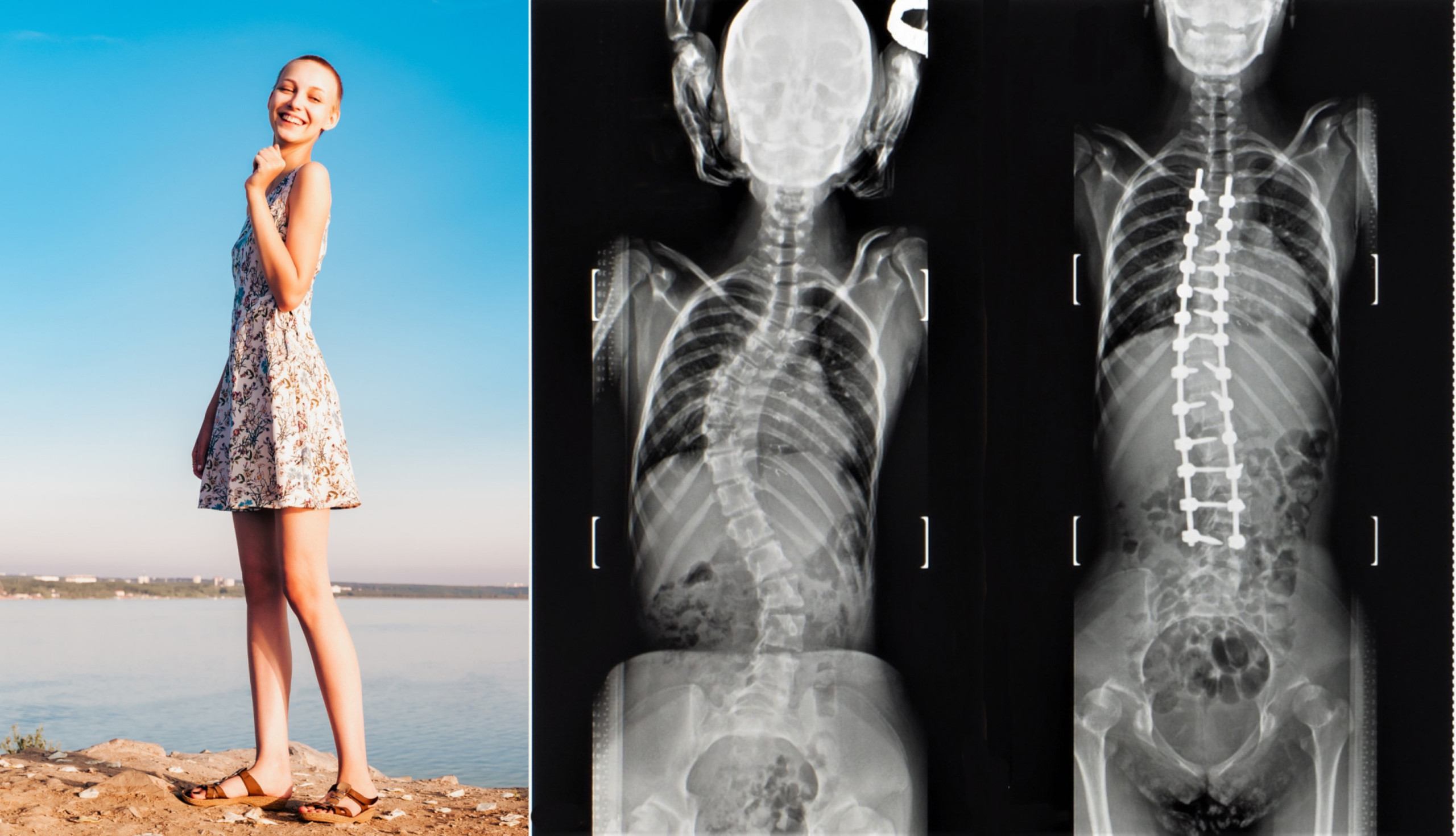 Síndrome de Marfan: los desafíos invisibles de la altura y la delgadez