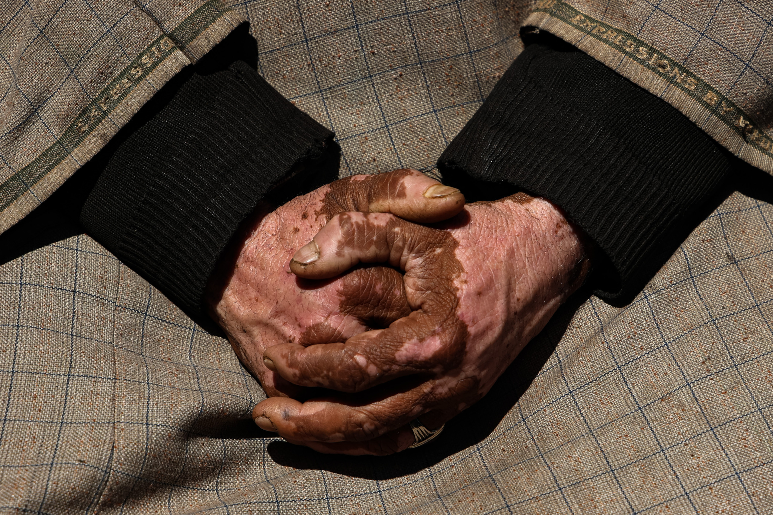 Autoimmune diseases: The facts behind the different types of immune ...