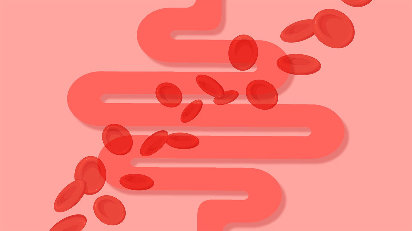 Crohn’s and Iron Deficiency Anemia: What’s the Link?