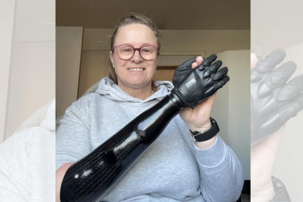 Woman born with one hand has life ‘transformed’ after treatment at ...
