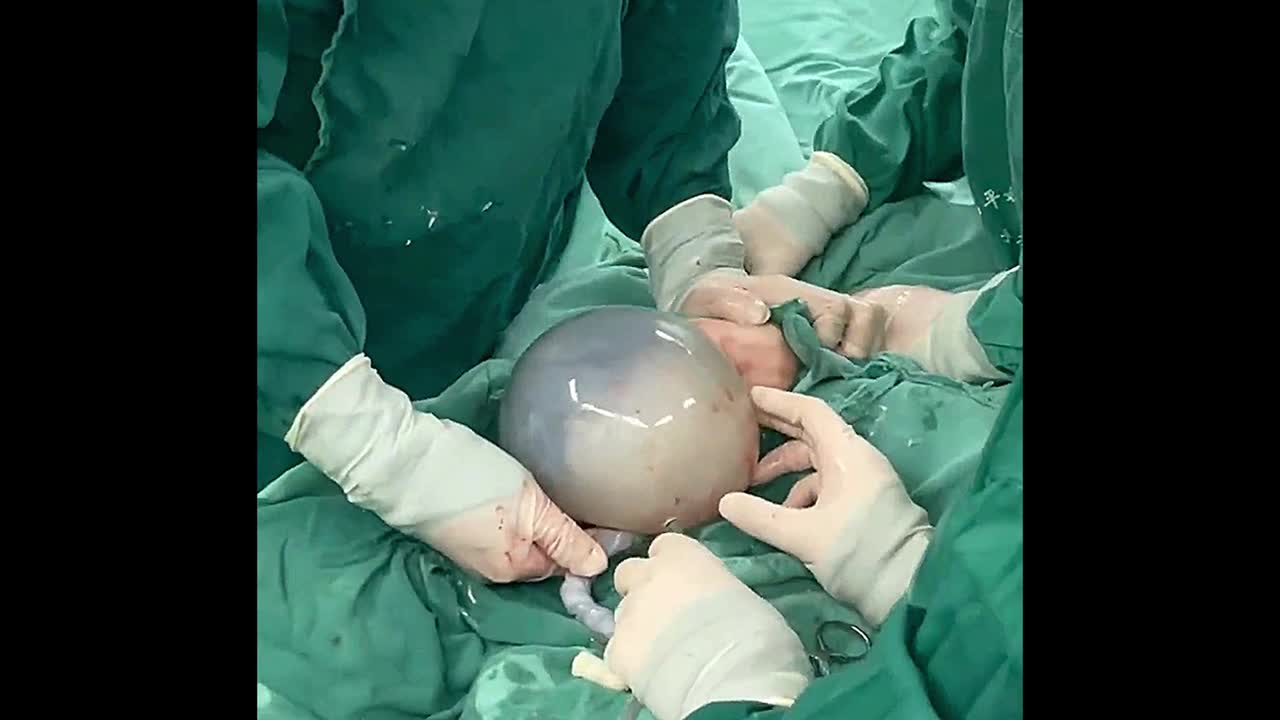 China: Baby born fully encased in amniotic sac in rare 1-in-80,000 birth