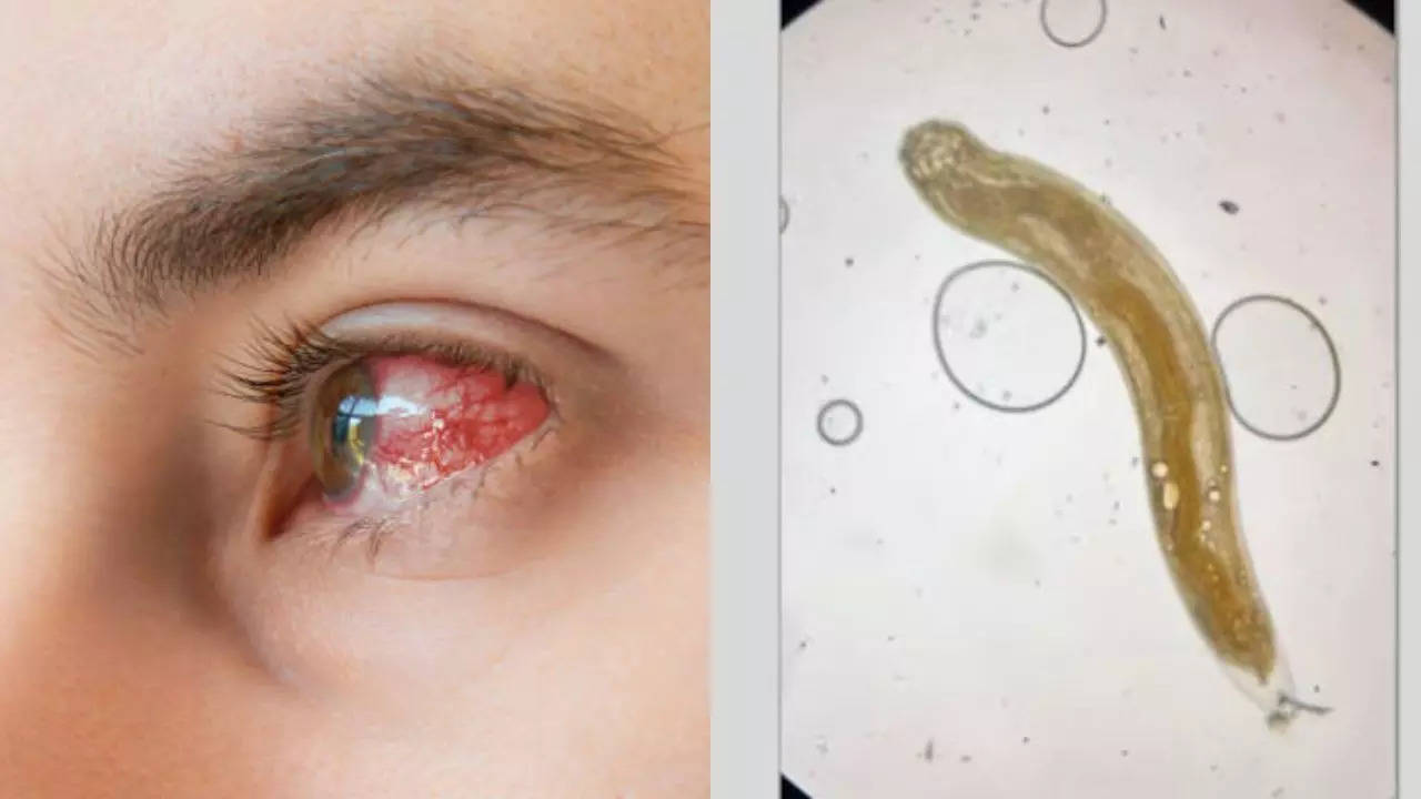 Doctors Remove A Live Worm From A Man's Eye; Know the SHOCKING Way It ...
