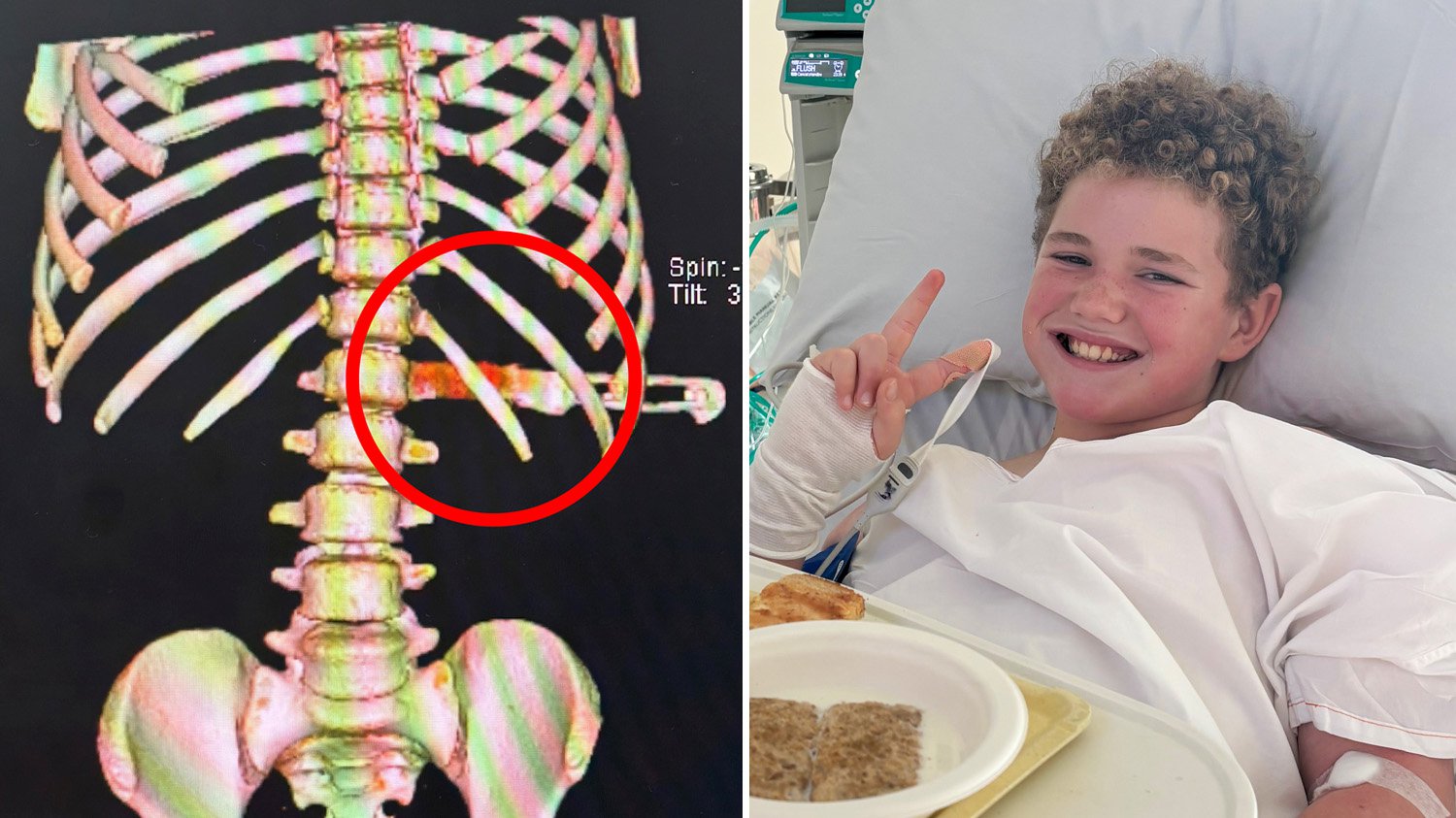 Boy impaled on steak knife when he fell backwards onto open dishwasher