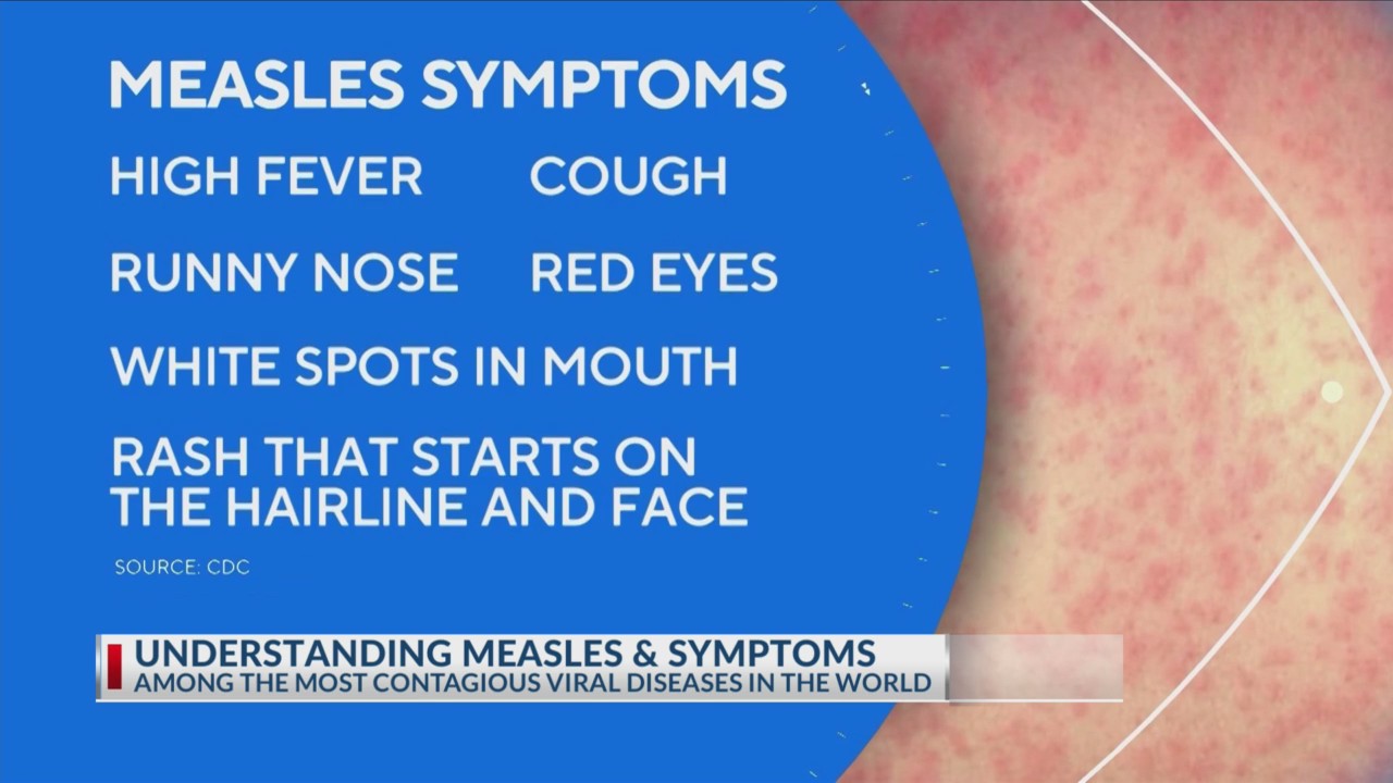 Understanding measles: Knowing signs, symptoms