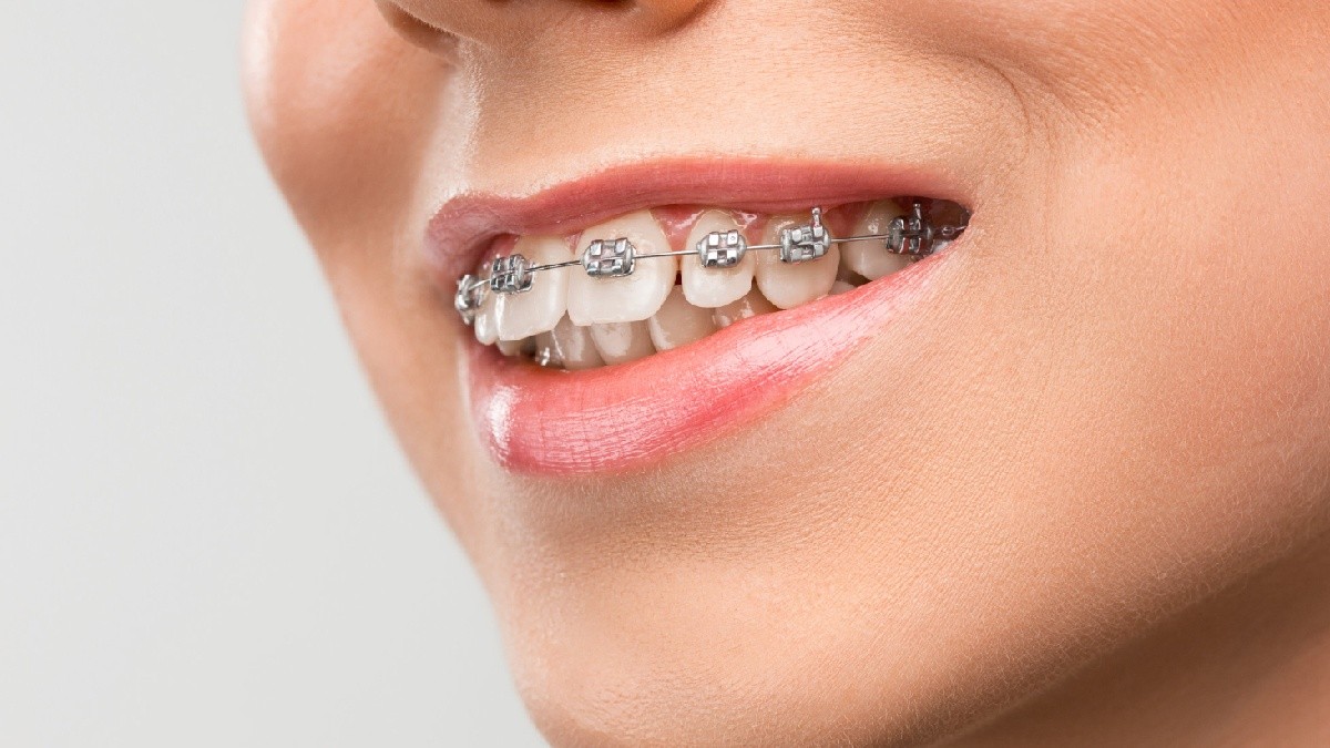 Esta es la mejor edad para usar brackets y alinear tu dentadura