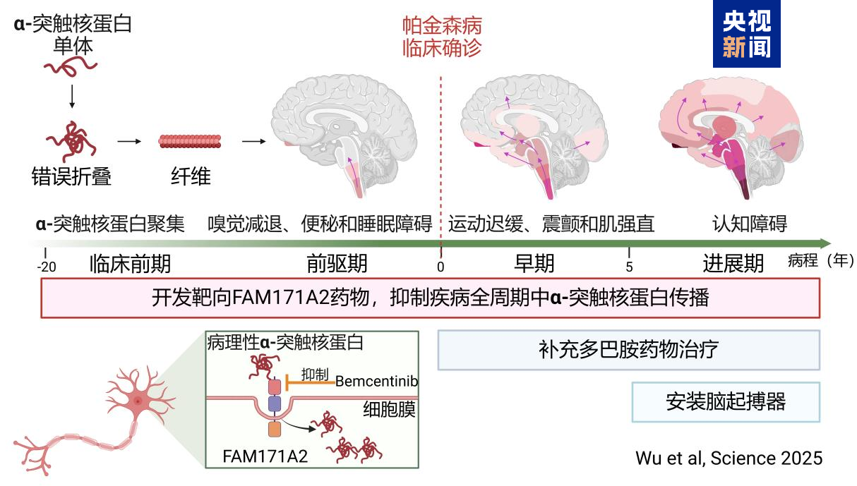 全球首次！复旦大学科研团队发现帕金森病全新治疗靶点