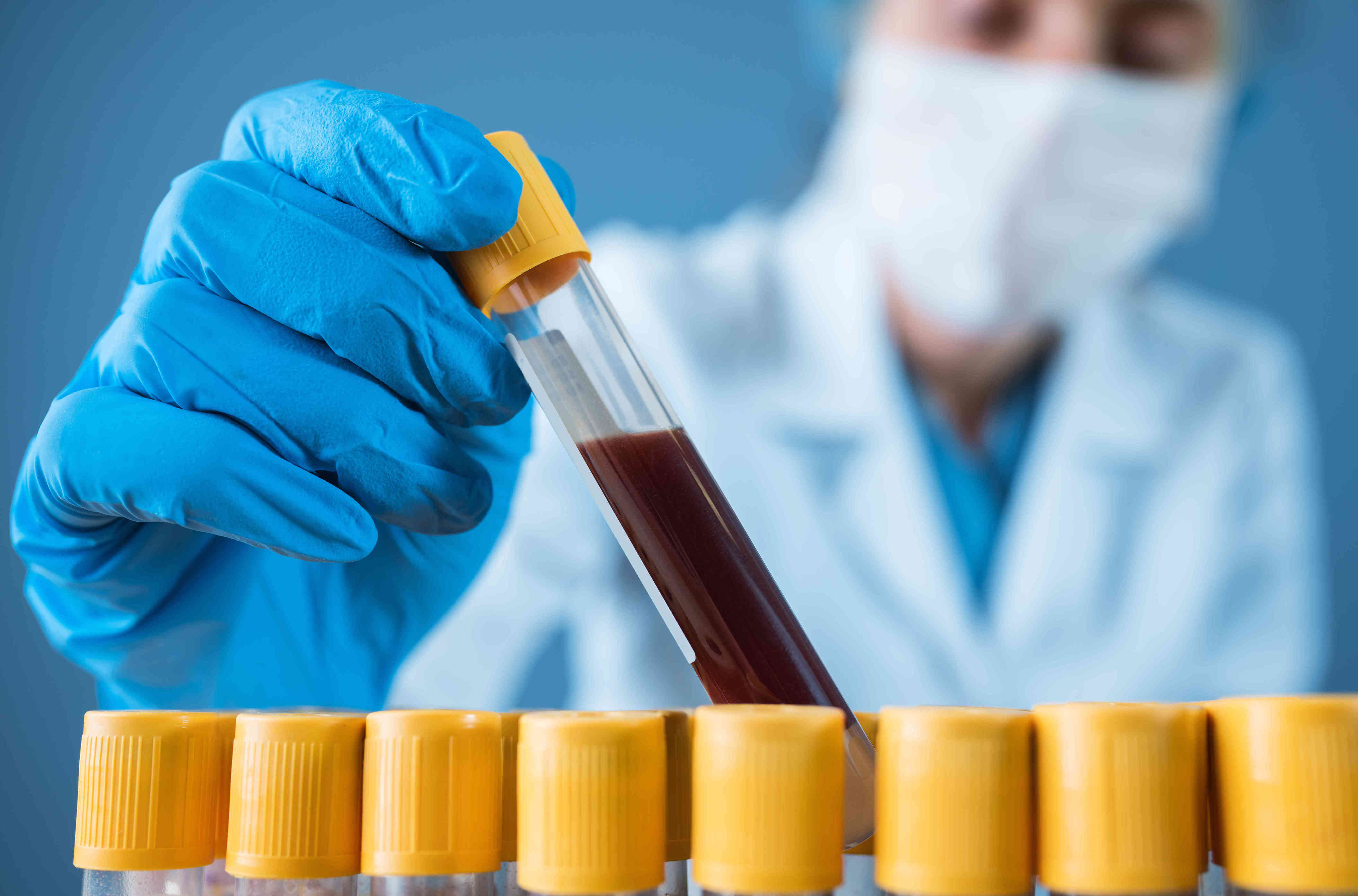 A/G Ratio Test Explained: Understanding Your High and Low Results