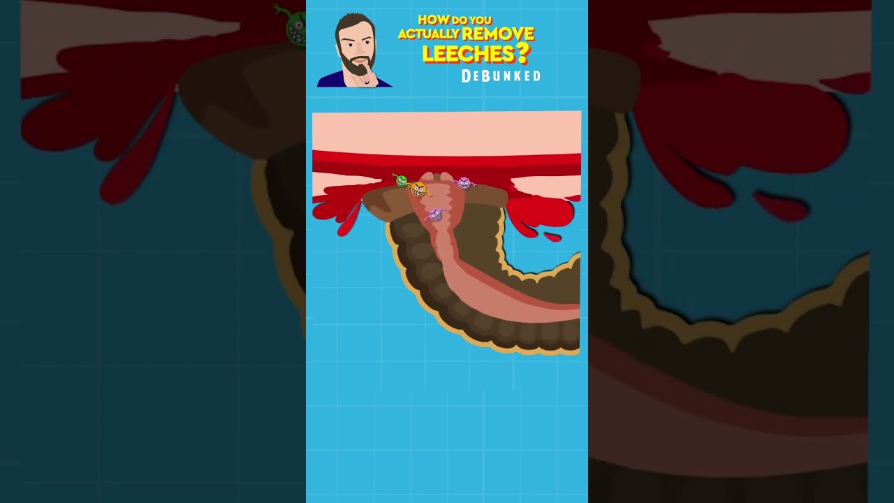 Learn the safest method for removing leeches without injury