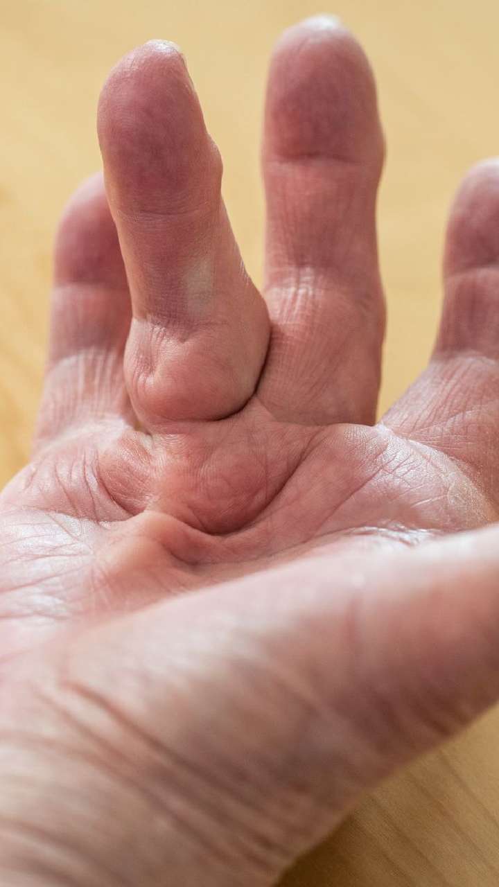 5 Natural Ways To Remove Ring Marks At Home