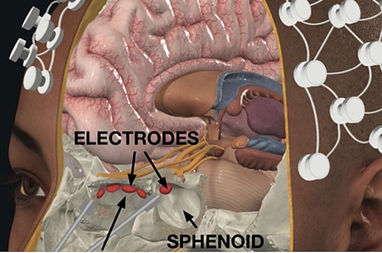 'DeepFocus' offers minimally invasive brain stimulation through the nose