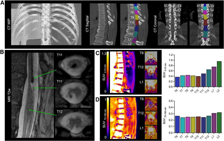 Novel PET tracer reveals potential for recovery in spinal cord injuries