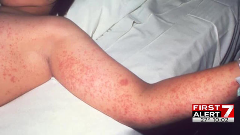 Measles vs. Flu vs. Covid vs. Allergies: Here’s what you need to know