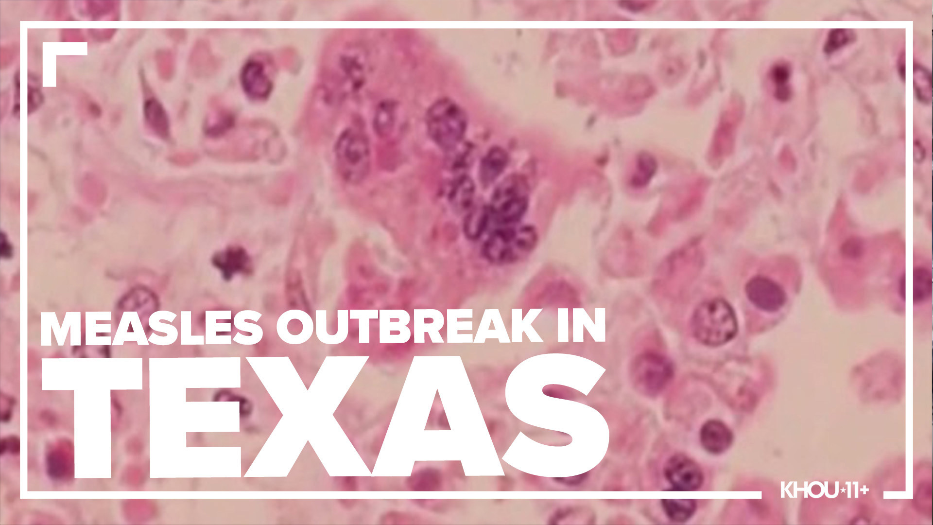 What is your level of measles immunity? There's a way to find out. What is your level of measles immunity? There's a way to find out.