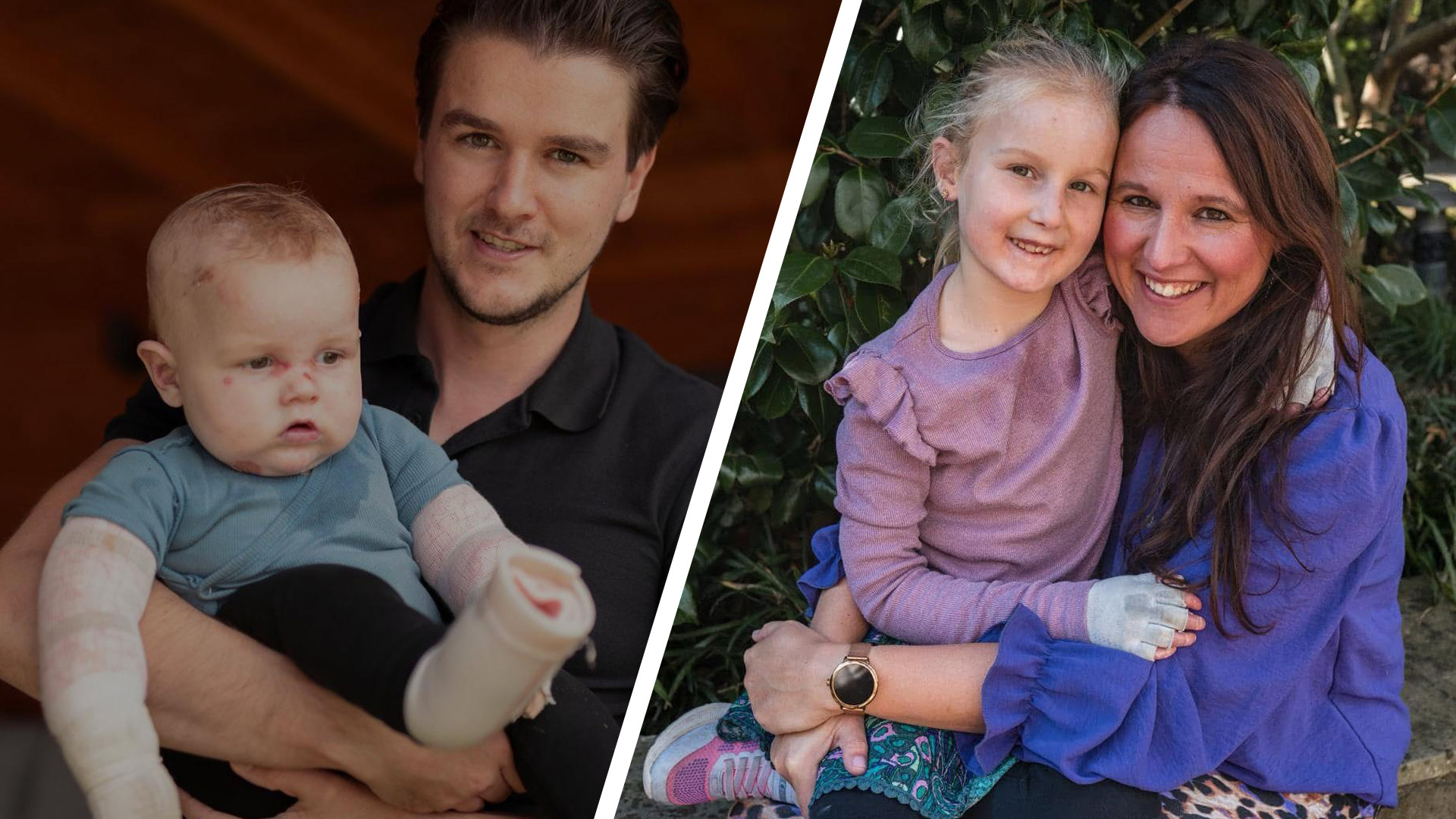 Gezinnen smeken om peperdure zalf voor hun 'vlinderkinderen' Dax (2) en ...