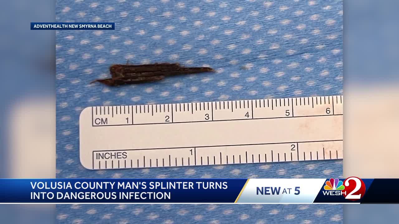 Volusia County man nearly loses hand after splinter turns into ...