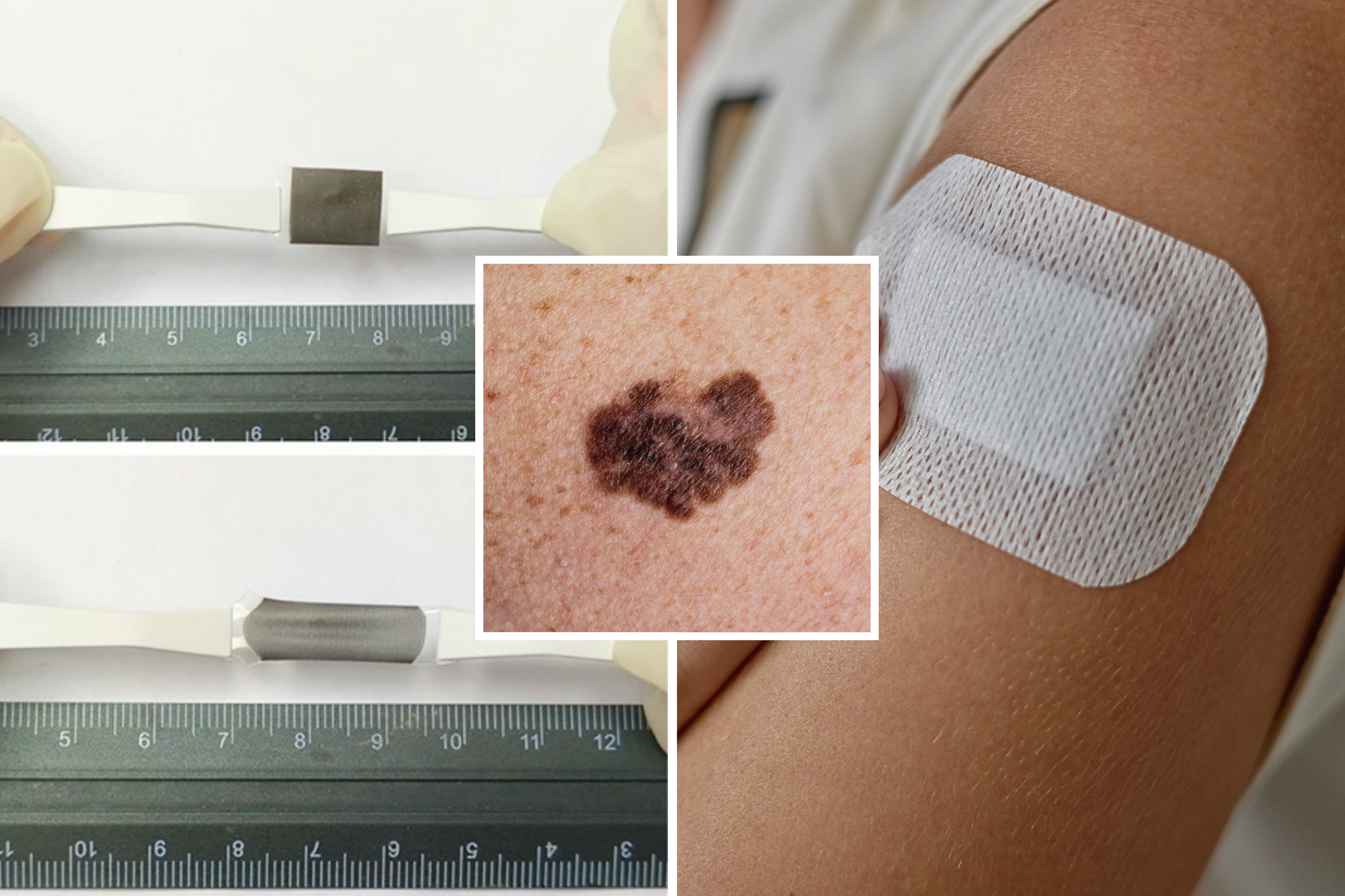 Heat-activated patch kills deadly skin cancer cells without surgery