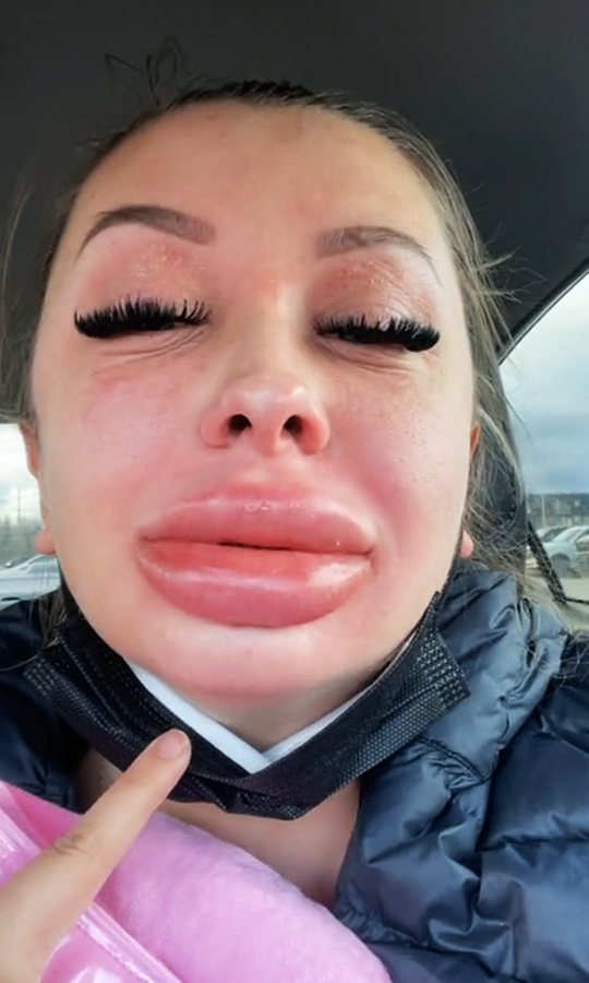 Filler ruined my face 😮