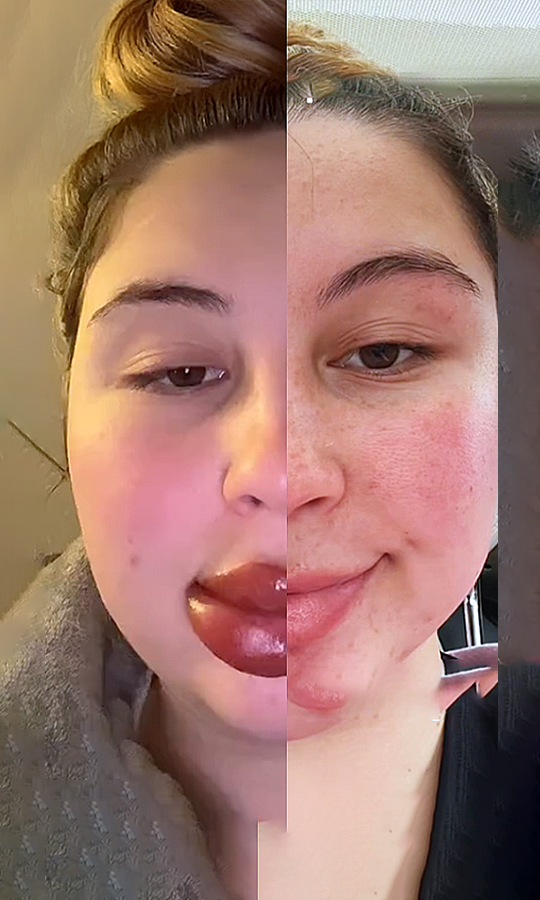 Lip blushing made my lips worse
