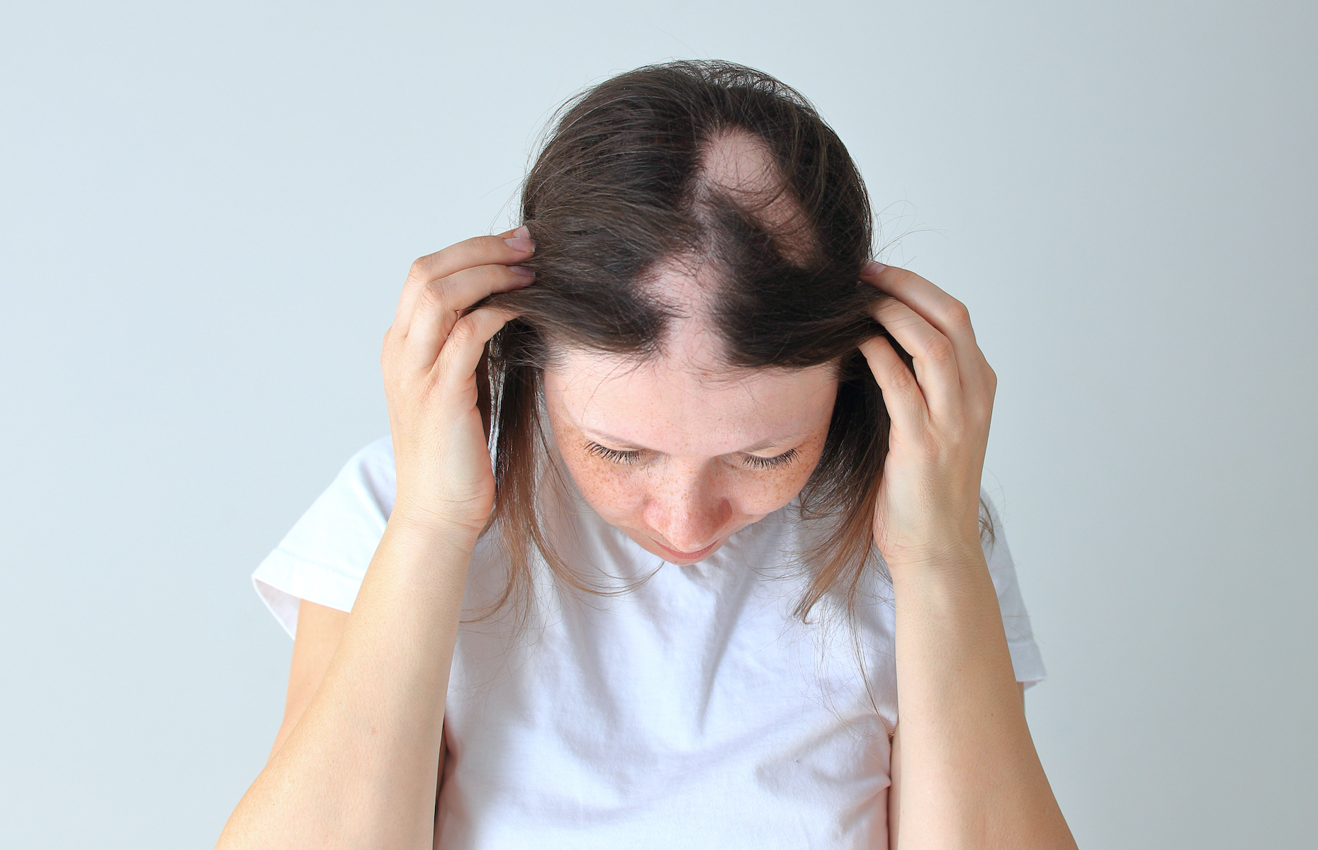 Alopecia: Causes, symptoms and treatments