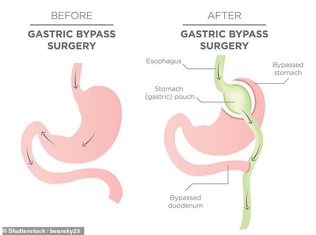 NHS slimming ops surge: Is your area top of the fat-loss surgery league?