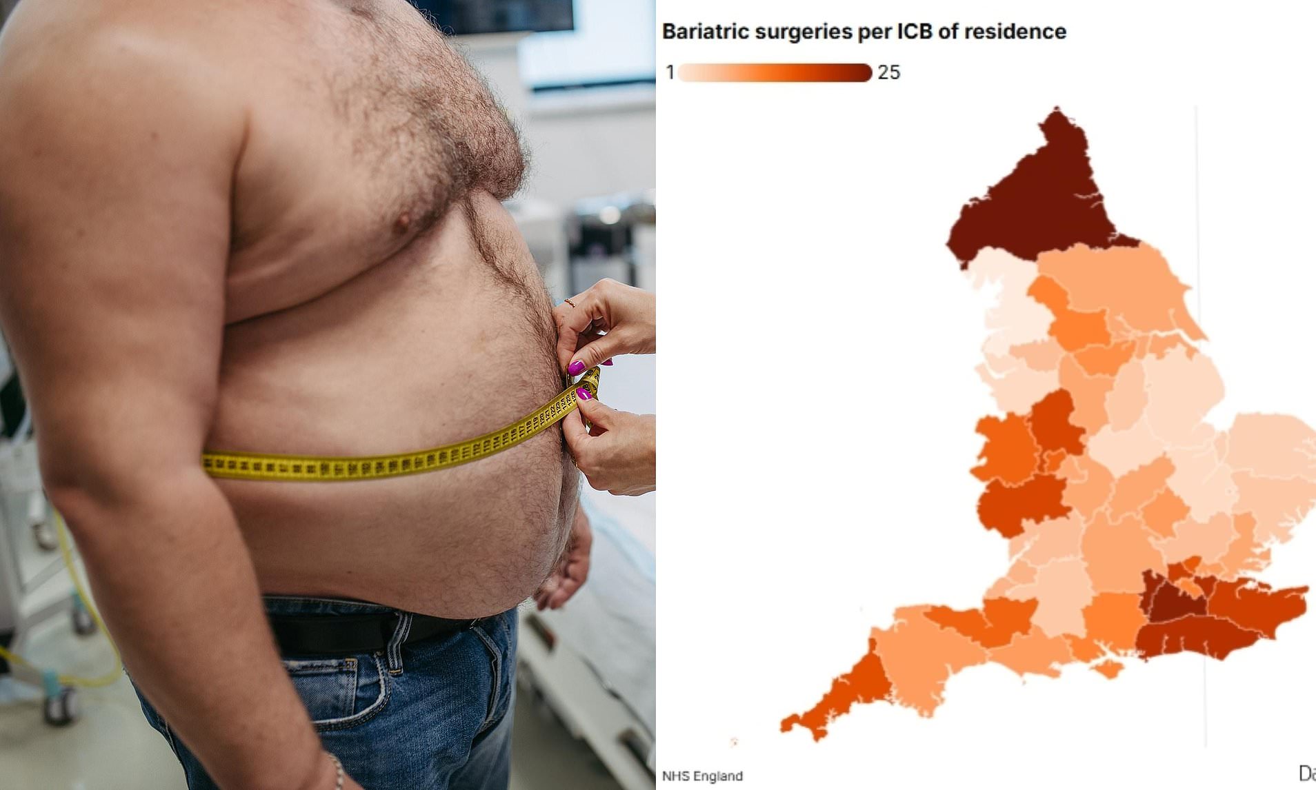 NHS slimming ops surge: Is your area top of the fat-loss surgery league?
