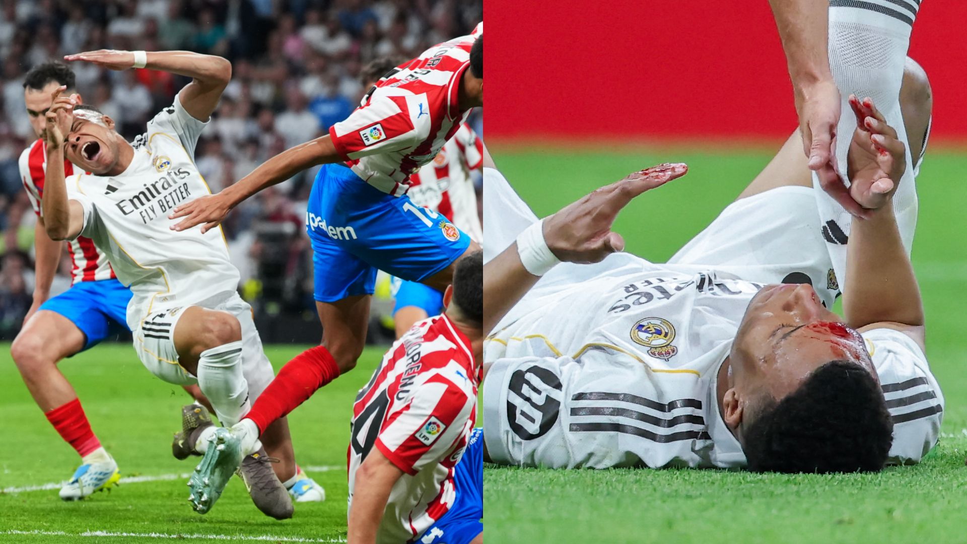 That's gotta hurt! Real Madrid's Kylian Mbappé left with bloody gash