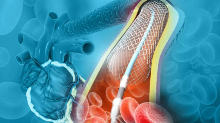 Stent failure explained: Can blocked heart arteries return after ...